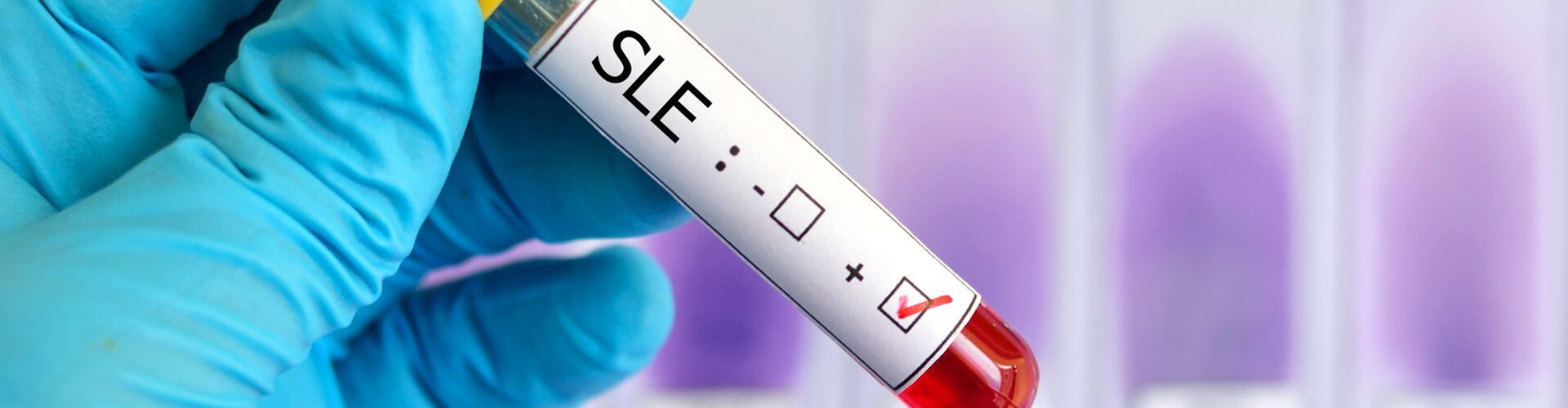 Ο Συστηματικός Ερυθηματώδης Λύκος μπορεί να αντιμετωπιστεί